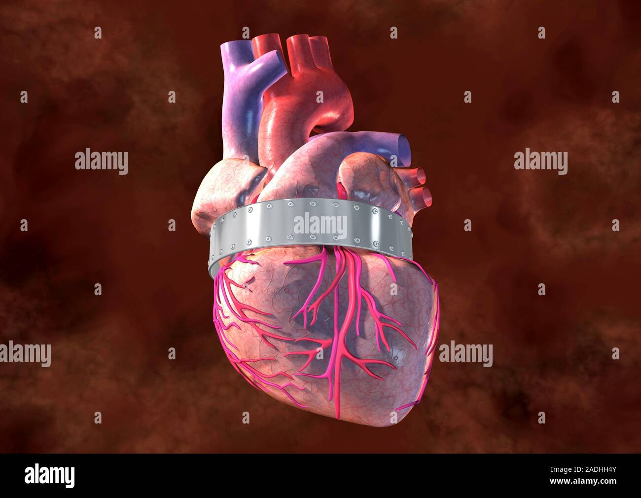 Angina, conceptual computer artwork. Heart being squeezed by a metal ...
