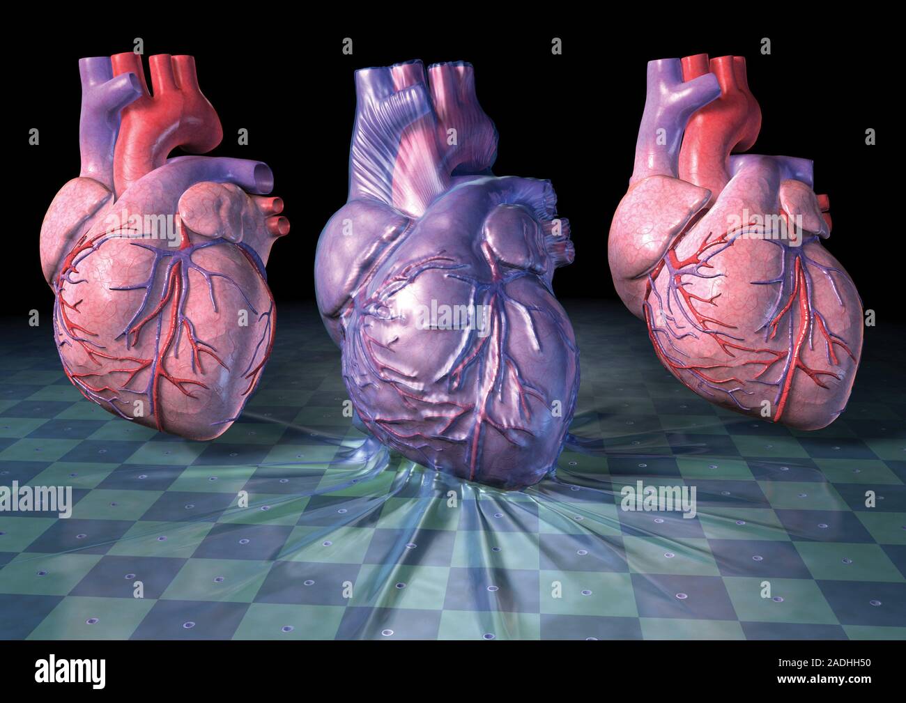 Heart attack. Conceptual computer artwork representing a myocardial ...