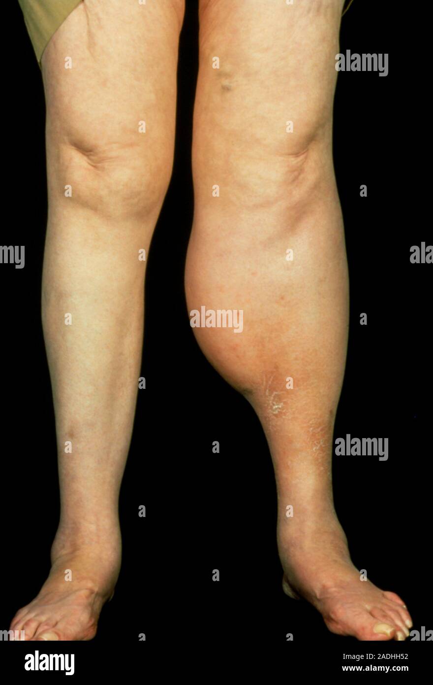 Photograph of a woman with a swollen left calf (right on image), caused ...
