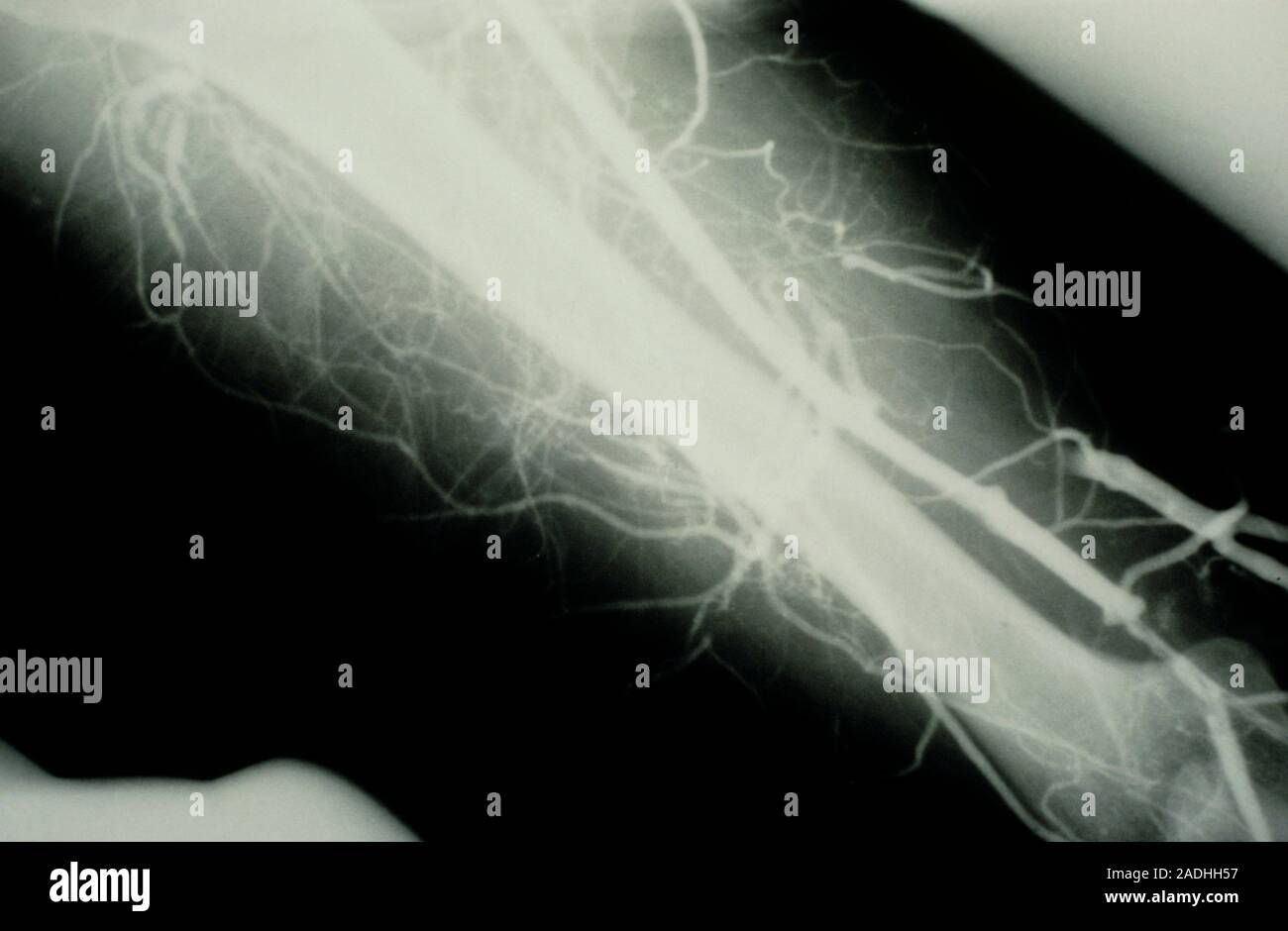 Venogram showing deep vein emboli, the blockage of a vein in the leg by ...