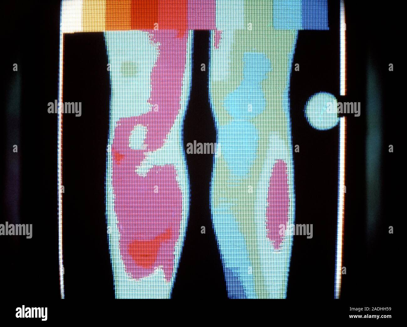 Thermogram of the lower legs, showing the heat distribution pattern of ...