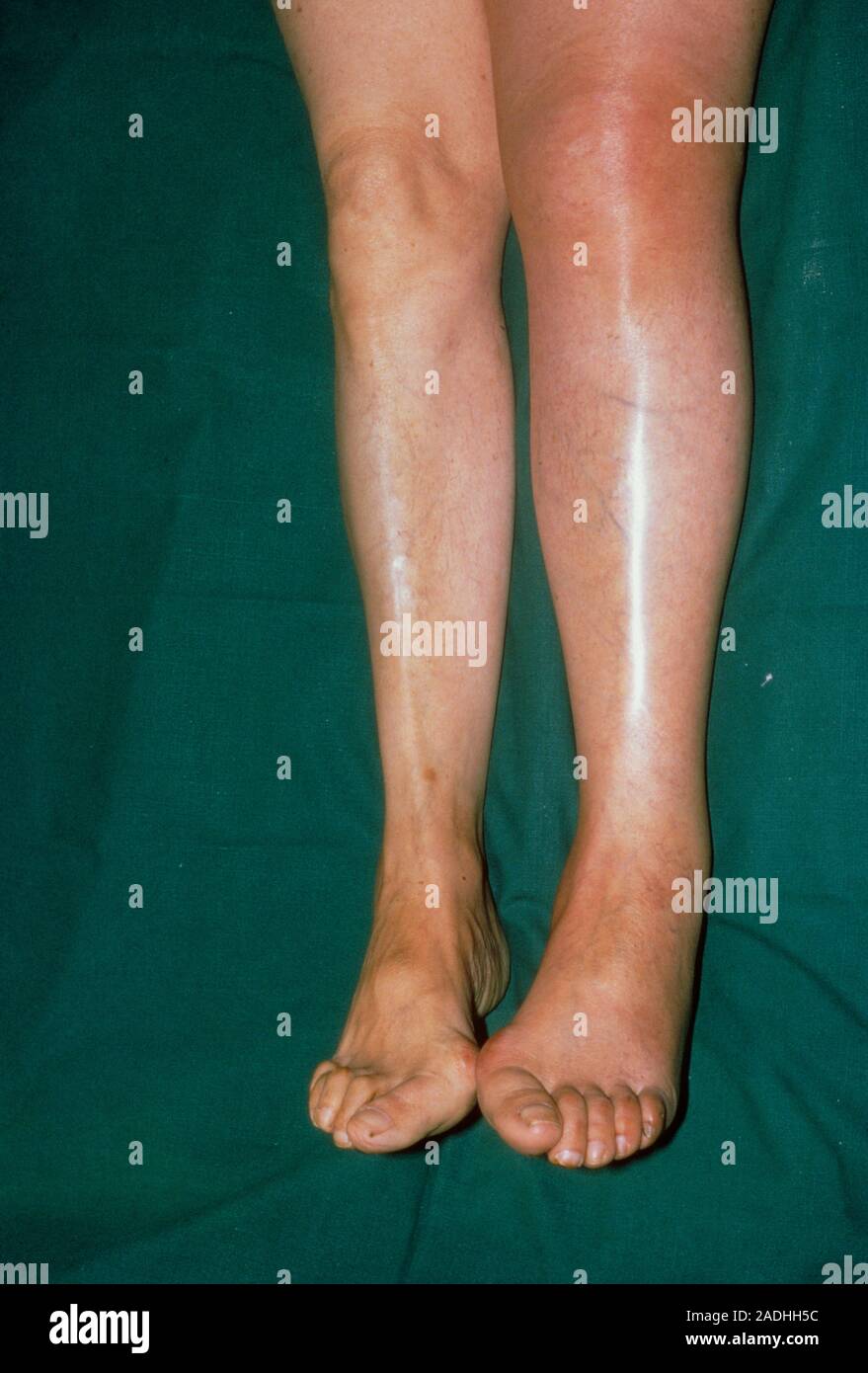Photograph Of A Womans Swollen Left Leg Caused By A Deep Vein Thrombosis Phlebothrombosis