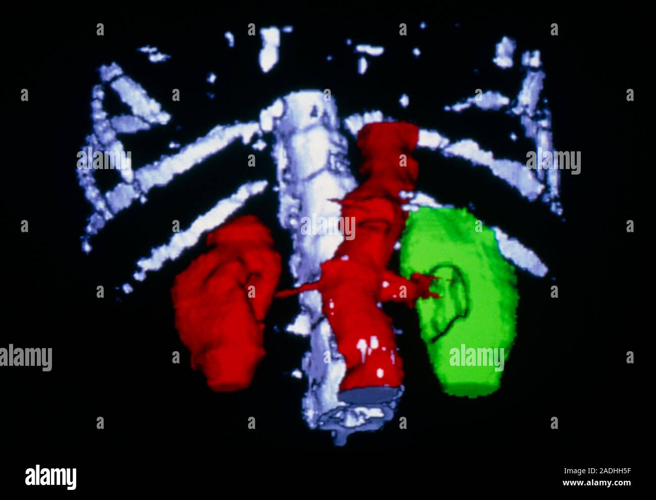 False-colour three-dimensional computed tomography (CT) scan of a ...