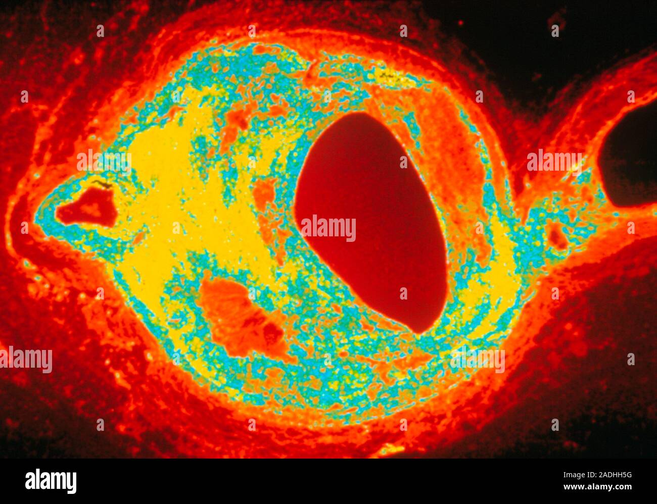 Digitised light micrograph of a cross-section through an atheroma ...