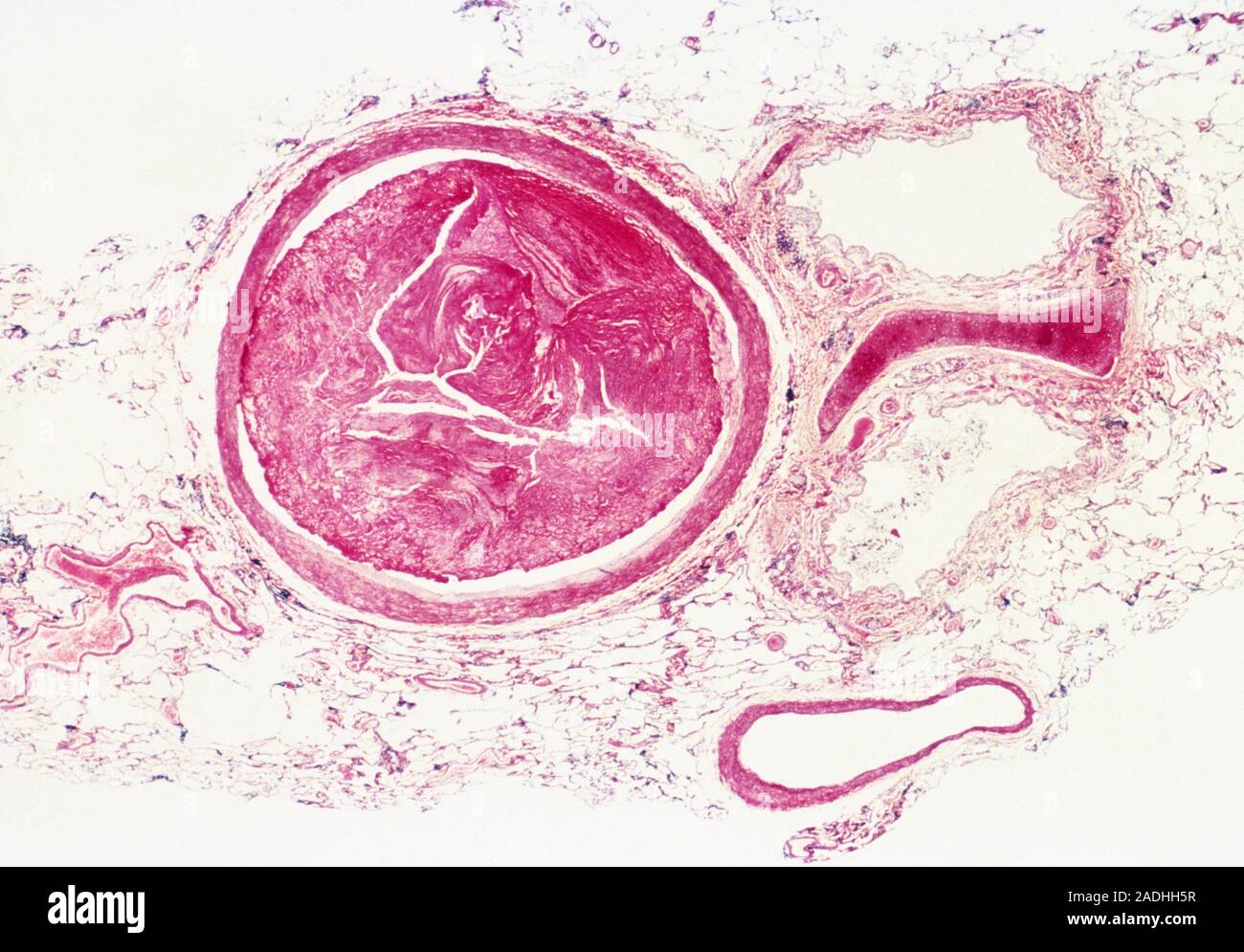 Light micrograph of human lung tissue showing a branch of the pulmonary ...