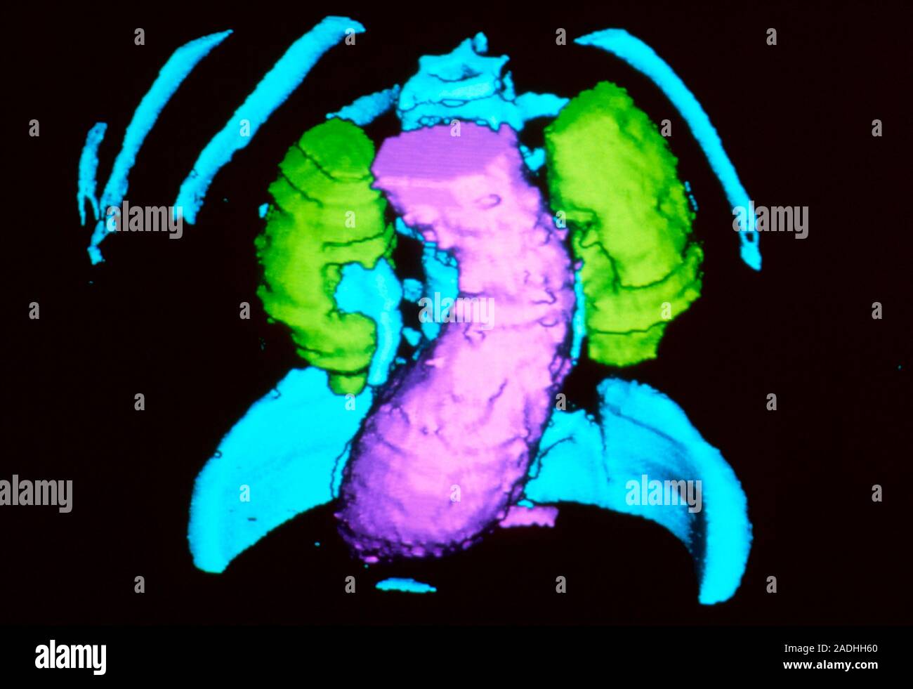 Aortic aneurysm. Coloured computed tomography (CT) 3-D scan showing the ...