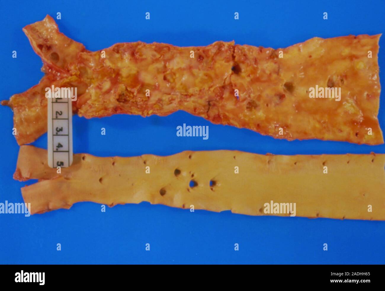 Atherosclerosis. Cross-sections showing a comparison between a healthy ...
