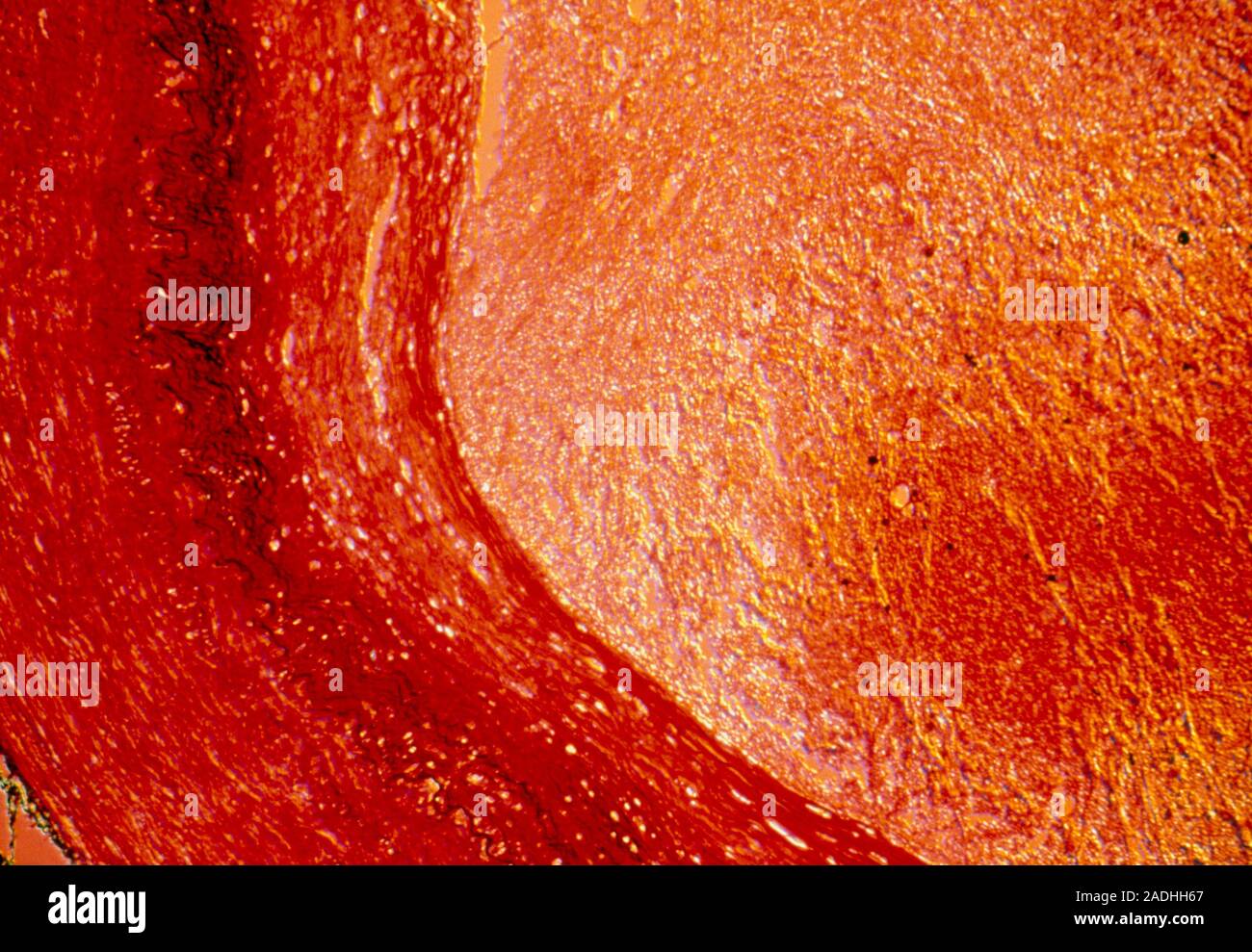 Atherosclerosis. Light micrograph of a cross section through an artery ...
