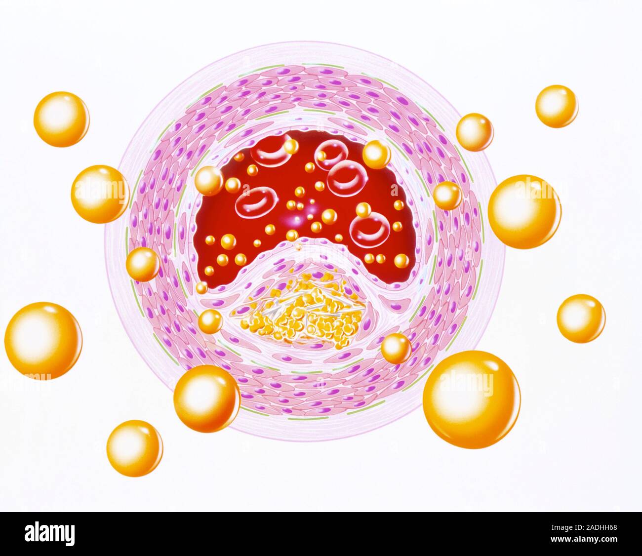 Hyperlipidaemia. Illustration of the narrowing of an artery ...