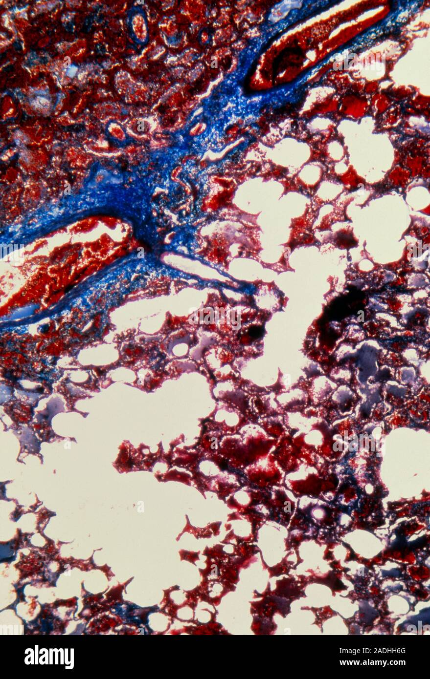 Lung infarction. Light micrograph of a section through an infarction in ...