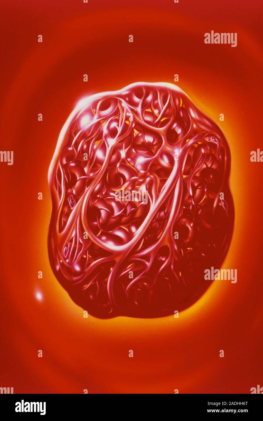 Thrombus. Illustration of a thrombus, an abnormal blood clot formed ...