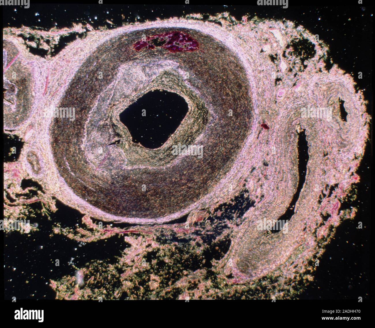 Atherosclerosis. Light micrograph of a cross section through an artery ...