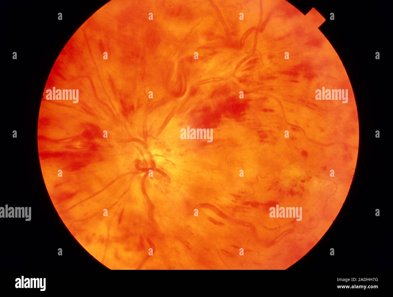 CRV retinal occlusion. Ophthalmoscopy view of the retina of the eye ...