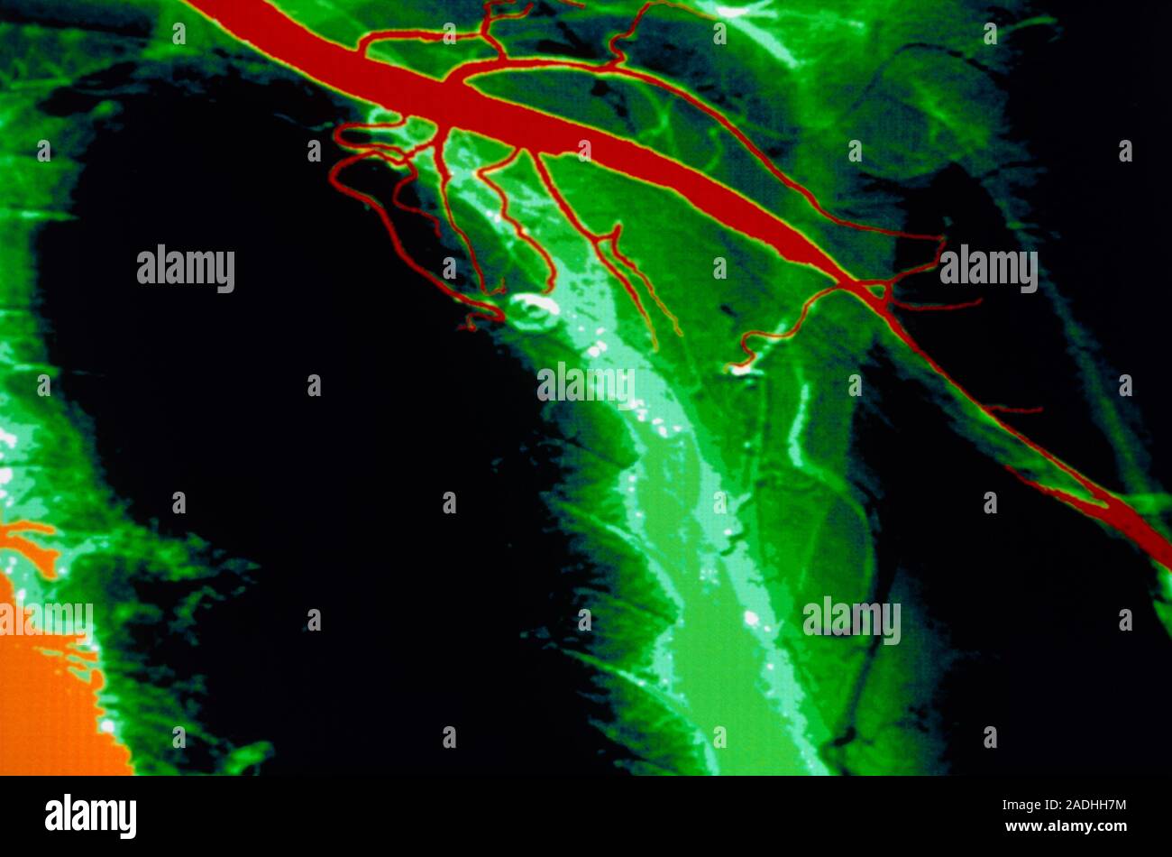 Thrombosis. Coloured X-ray angiogram showing thrombosis in the left ...
