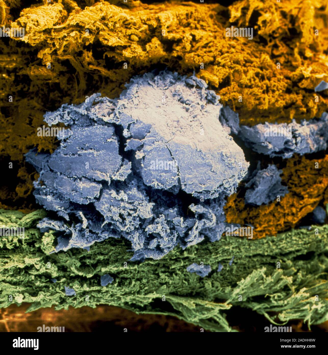 Atherosclerosis. Coloured Scanning Electron Micrograph of a plaque ...