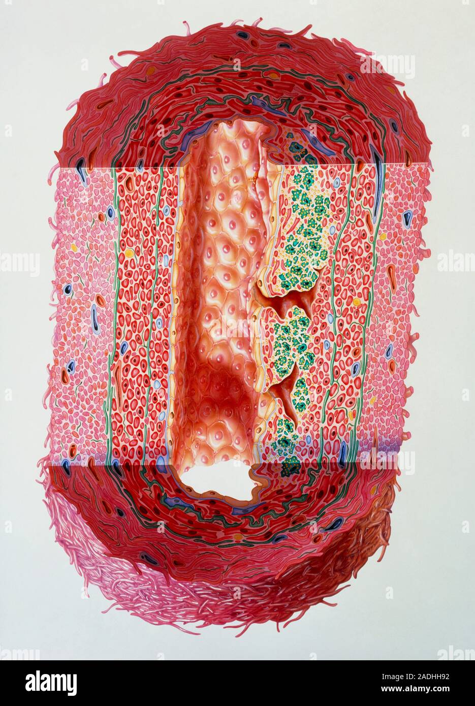 Atheroma. Cutaway illustration of the inside of a human artery showing ...