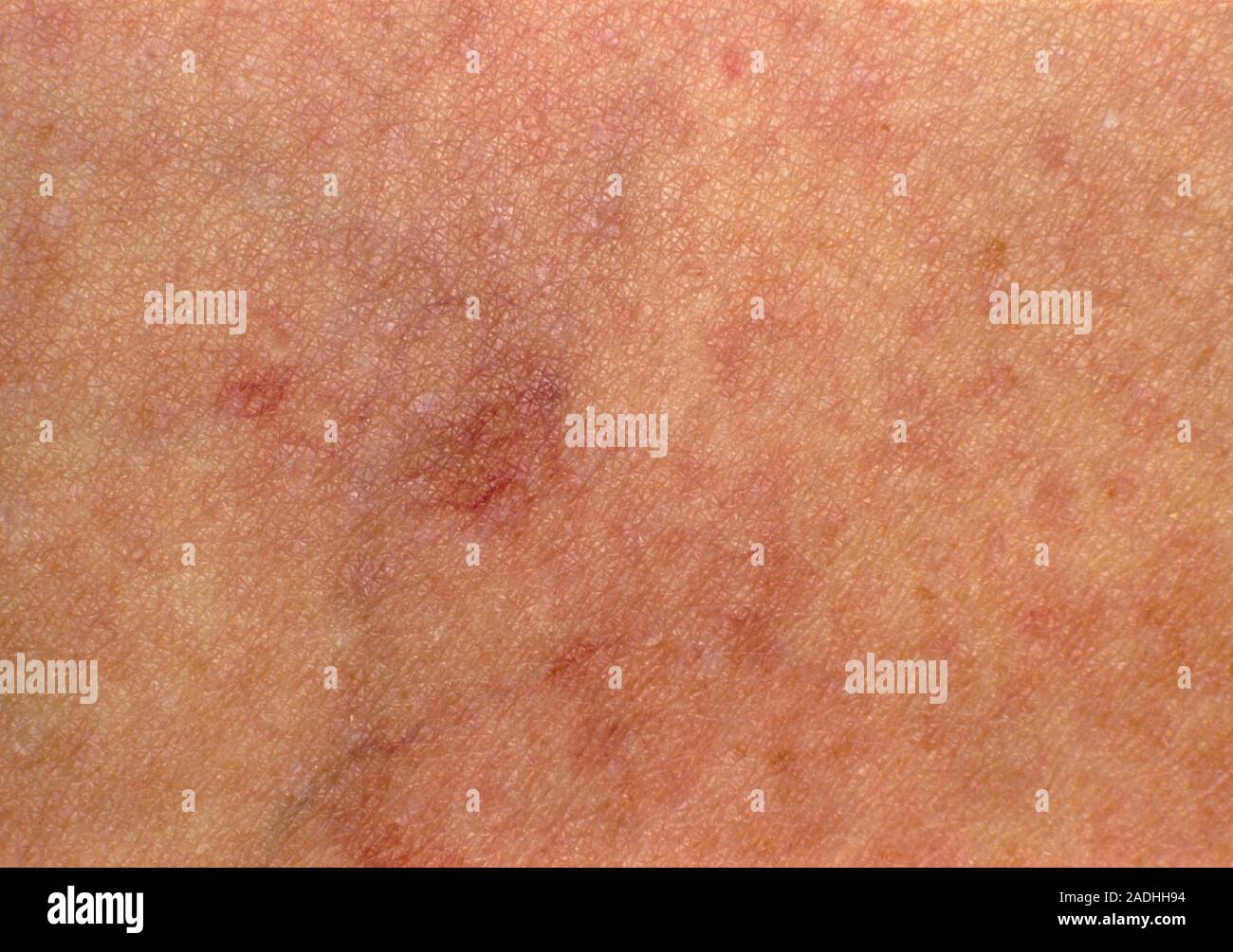 Telangiectasia (Image 1 of 2). Close-up of the skin of a patient ...