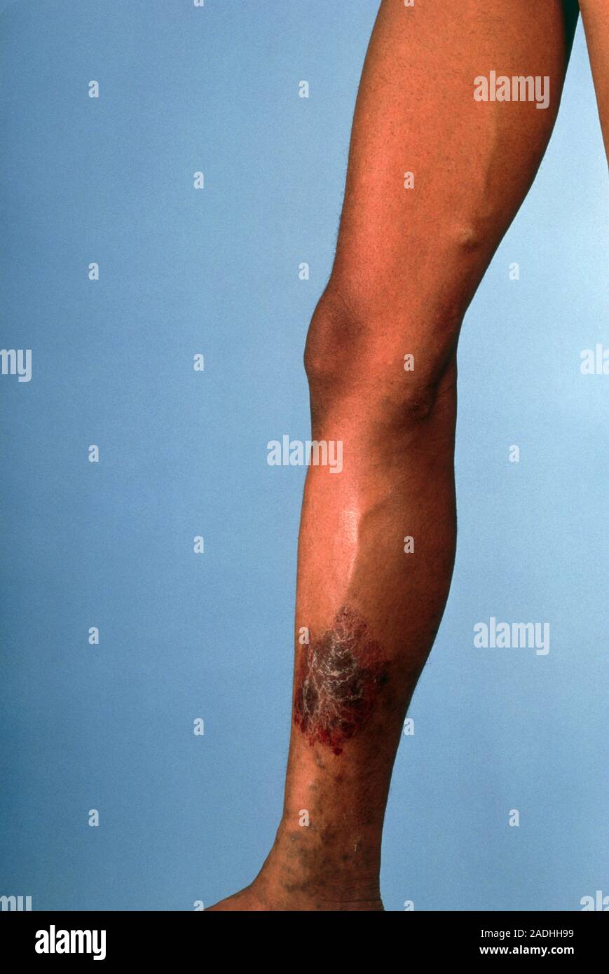 Venous insufficiency. Leg with discolouration and flaking skin due to ...