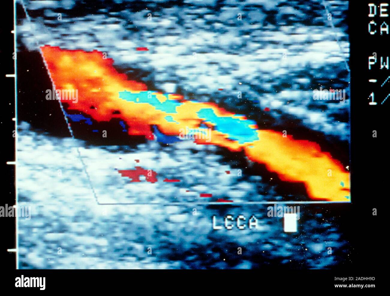 Atherosclerosis & clot formation. Coloured doppler ultrasound scan ...
