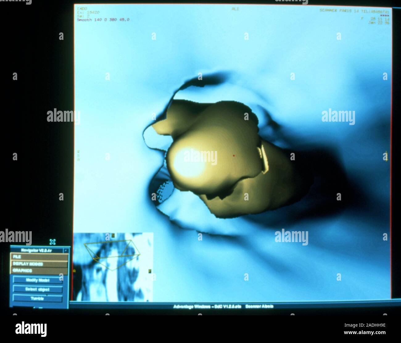 Blocked artery. Three-dimensional computed tomogr- aphy (CT) scan of an ...