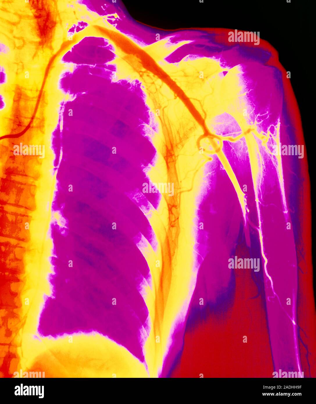 Arterial embolism. Coloured angiogram (X-ray) showing an embolus ...