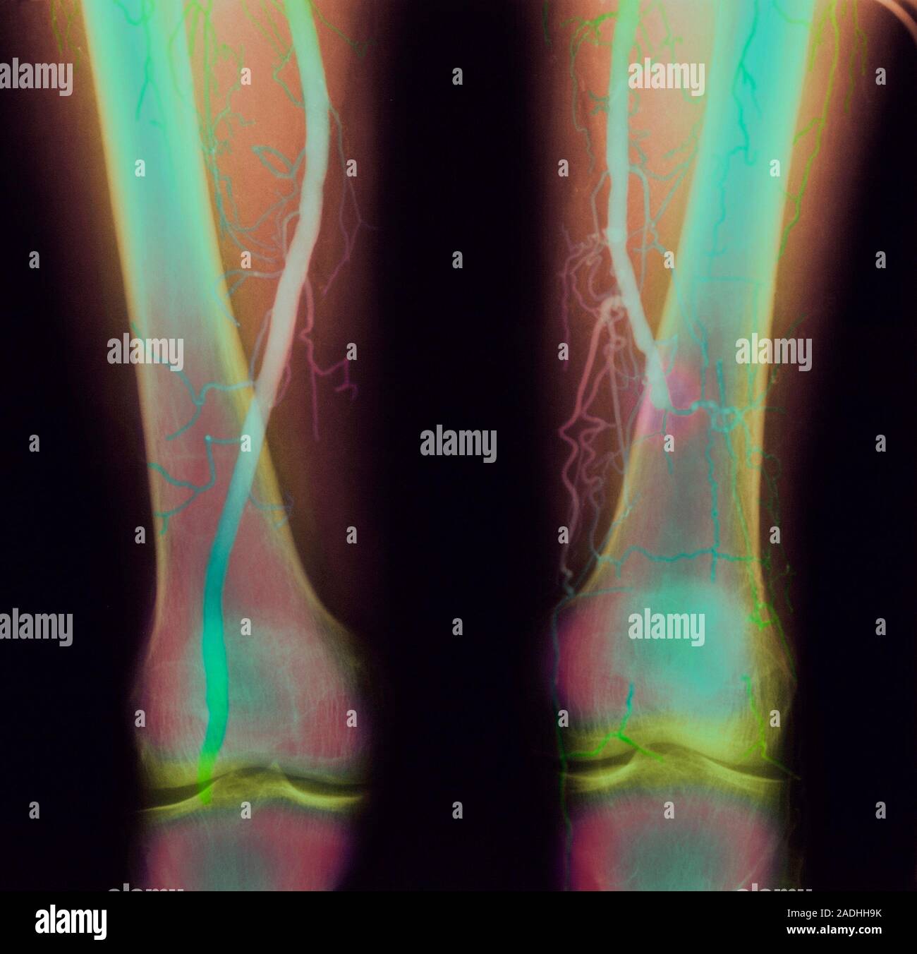 Blocked Femoral Artery Coloured Angiogram Arterial X Ray Of A