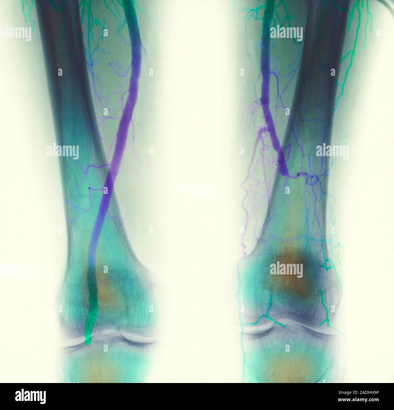 Blocked Femoral Artery Coloured Angiogram Arterial X Ray Of A