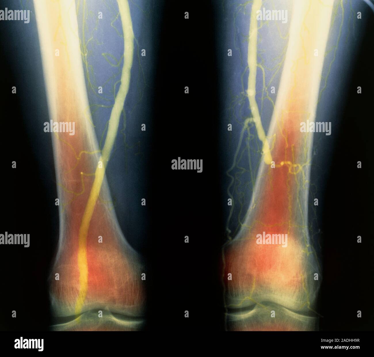 Blocked femoral artery. Coloured angiogram (arterial X-ray) of a blockage (centre right) in the ...