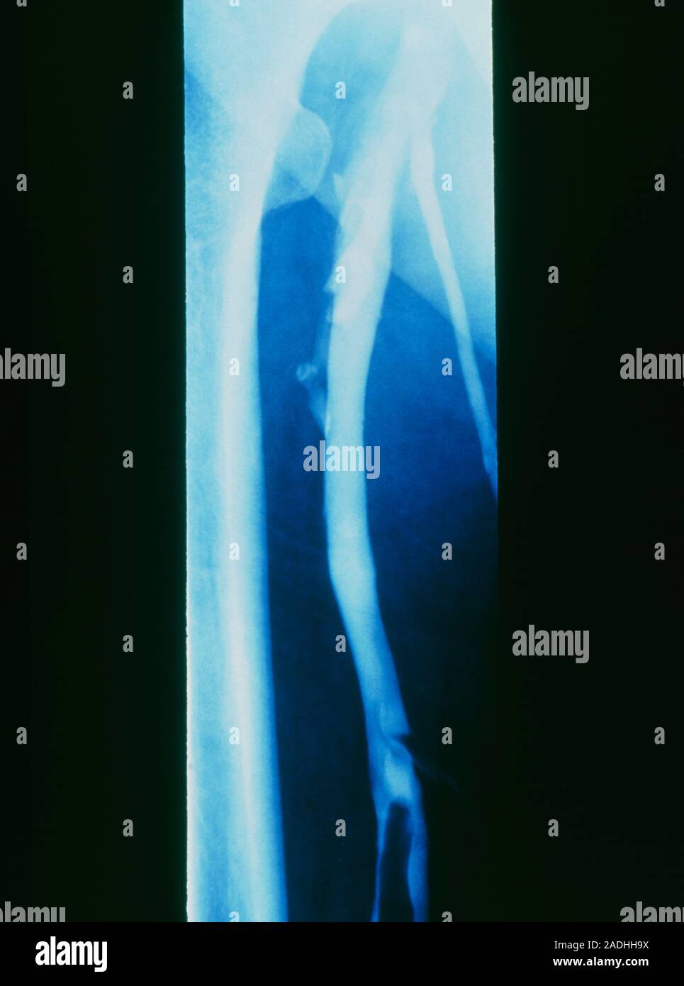 Thrombophlebitis. Coloured venogram (X-ray) of superficial ...
