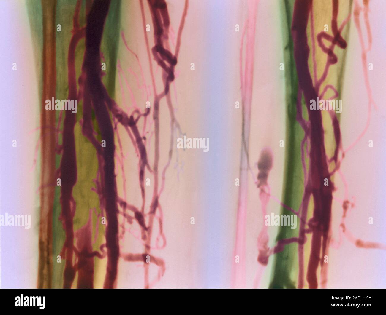 Deep vein thrombosis. Coloured angiograms (X-rays) taken from the front ...