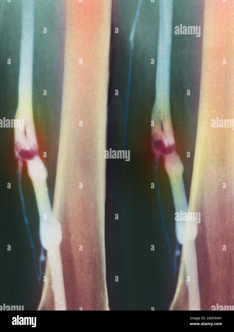 Deep vein thrombosis. Coloured angiograms (X-rays) of two views of a ...