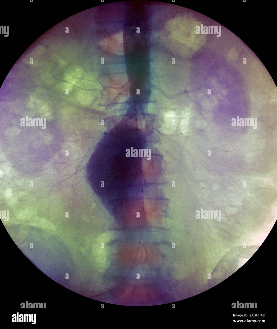 Aortic aneurysm. Coloured angiogram (X-ray) of the abdomen of a 62-year ...