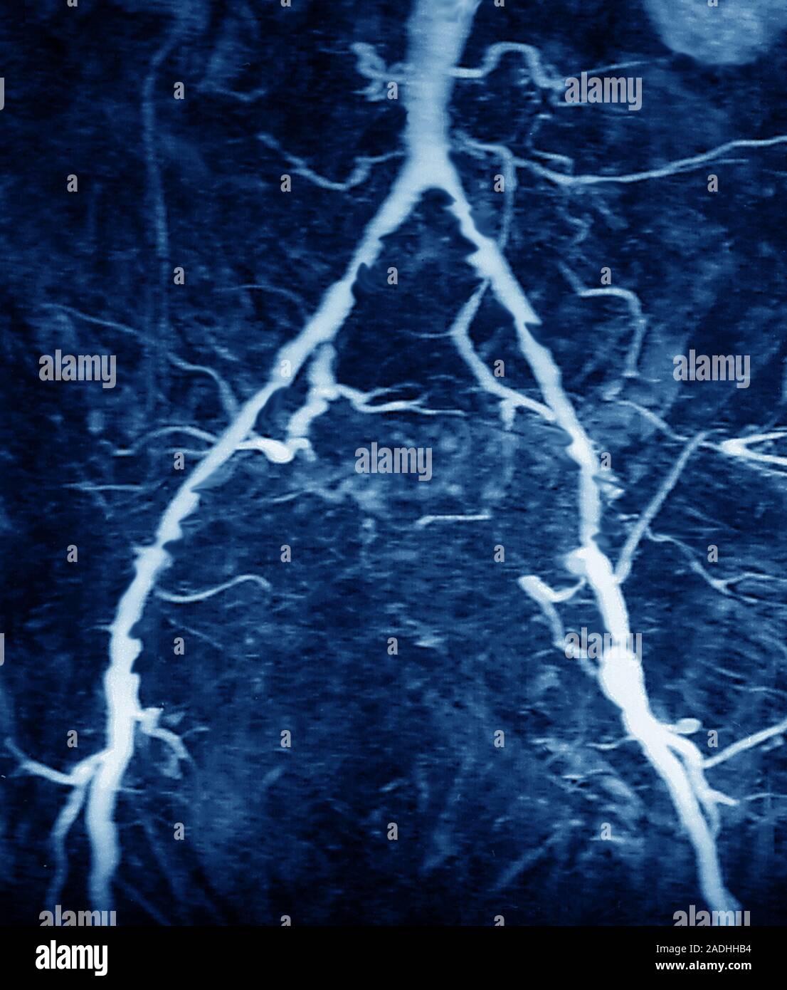 Arteritis. Coloured coronal (frontal) magnetic resonance angiography ...