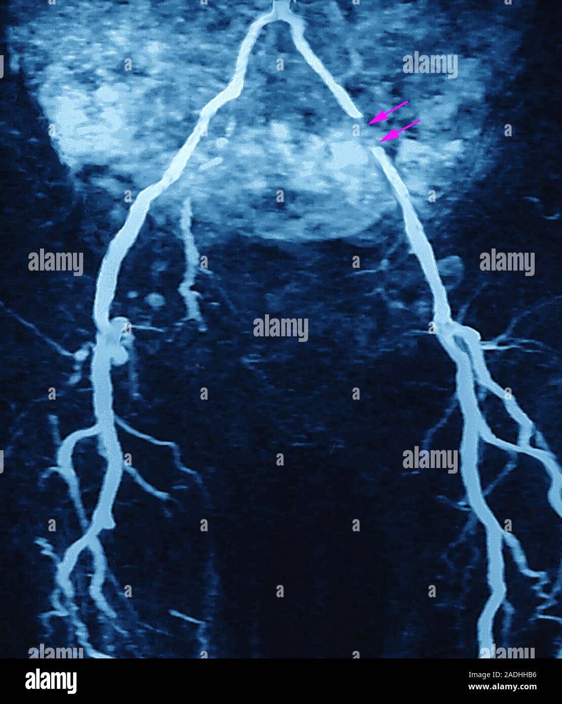 Arterial stent. Coloured coronal (frontal) MRA (magnetic resonance ...