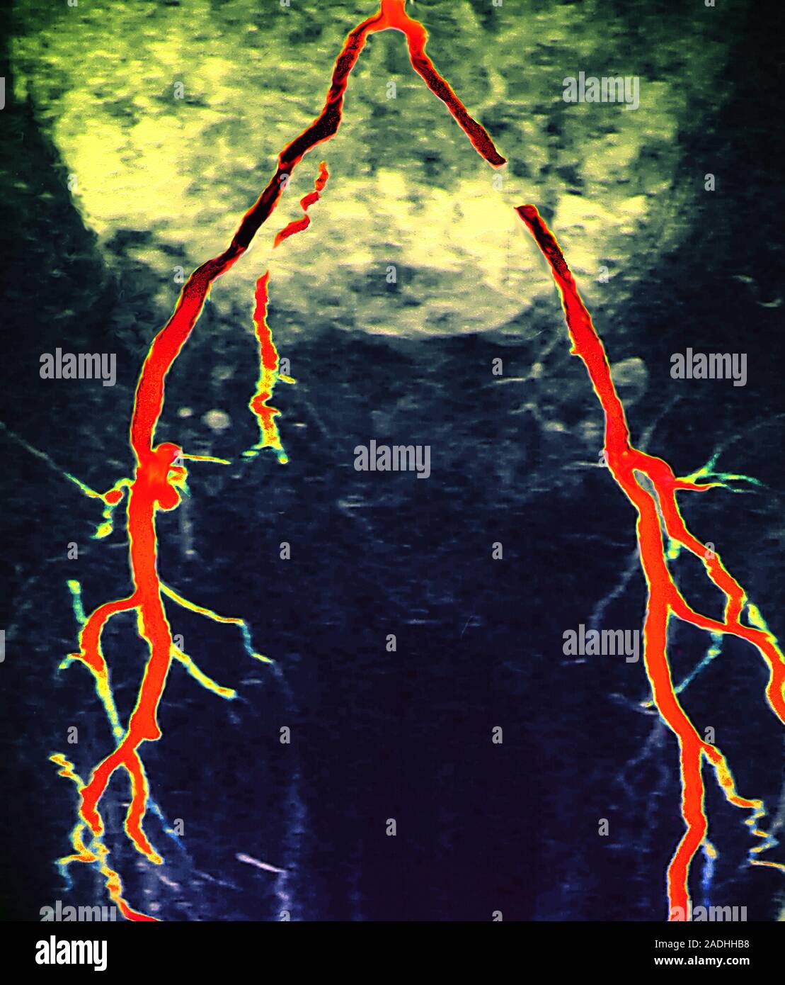 Arterial stent. Coloured coronal (frontal) MRA (magnetic resonance ...