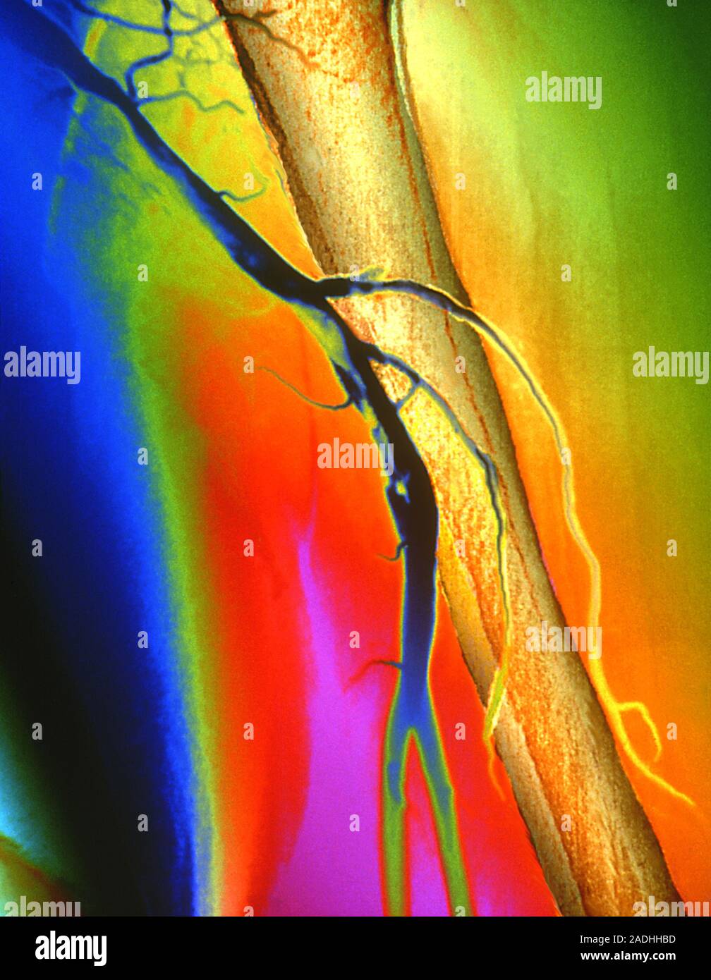 Arm thrombosis. Coloured X-ray angiogram of a thrombus (blood clot ...