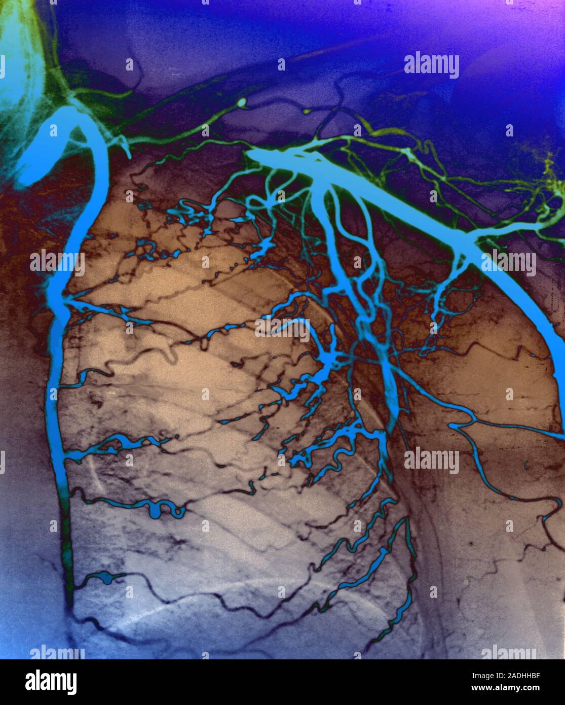 Takayasu's disease. Coloured X-ray angiogram of a thrombosis (blockage ...