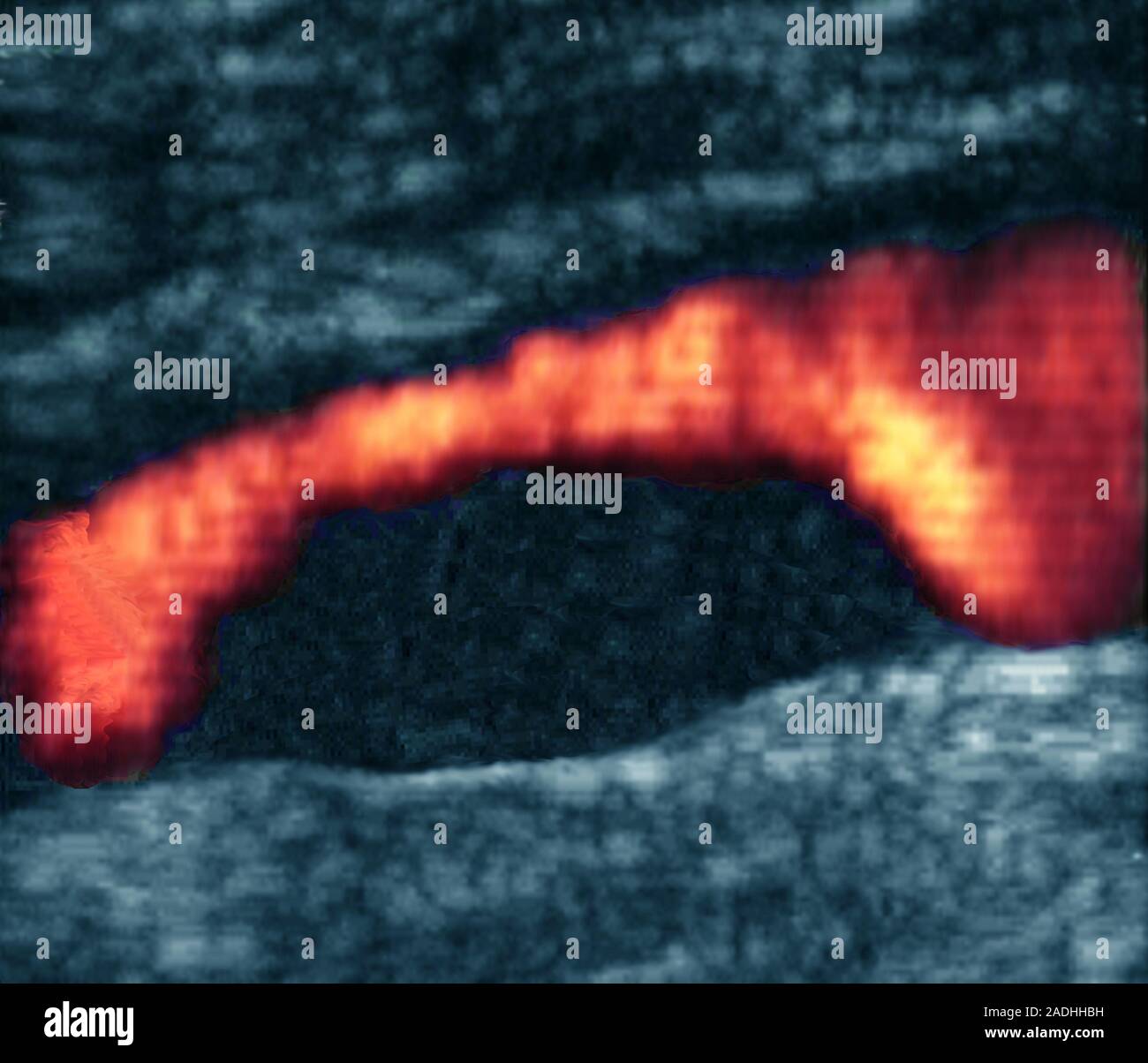 Atheroma plaque. Power Doppler ultrasound scan of reduced blood flow ...
