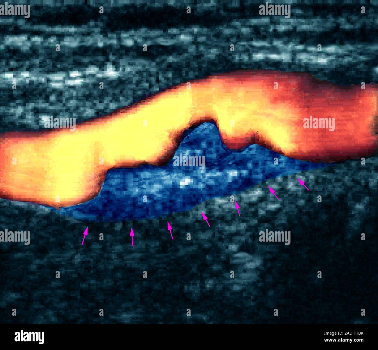 Atheroma plaque. Power Doppler ultrasound scan of turbulent blood flow ...