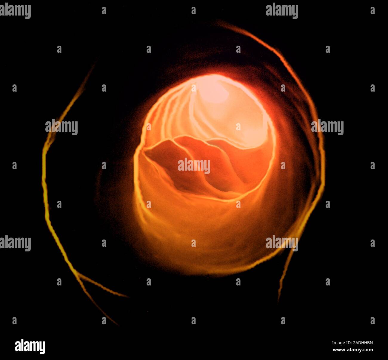 Atherosclerosis. Coloured three-dimensional computed tomography (CT ...