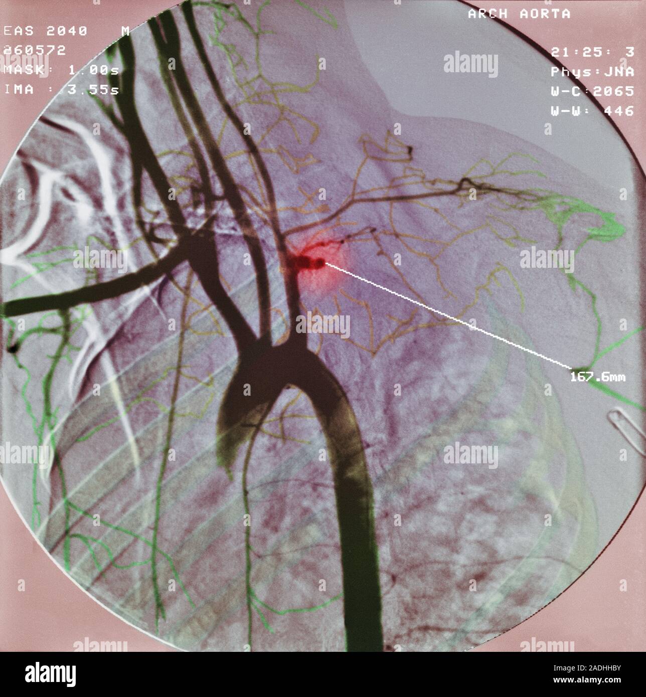 Arterial occlusion. Coloured chest X-ray angiogram showing an occlusion ...