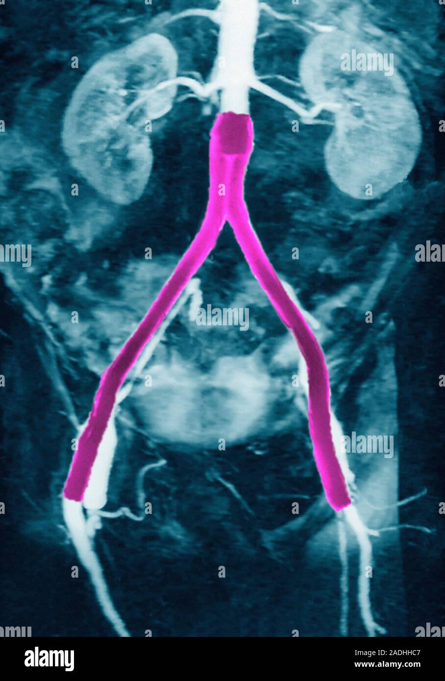 Aortic bypass. Magnetic resonance angiography (MRA) scan of the abdomen ...