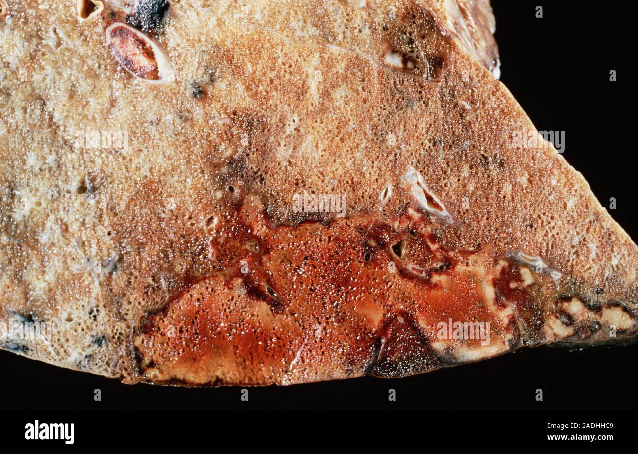 Lung infarction. Gross clinical specimen of a sectioned lung showing an ...