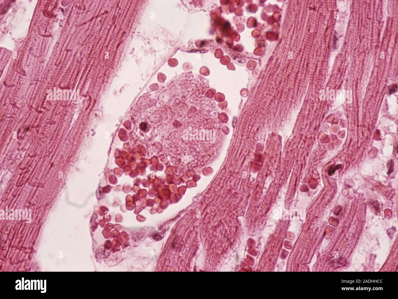 Blood clot. Light micrograph of a section through human muscle fibres ...