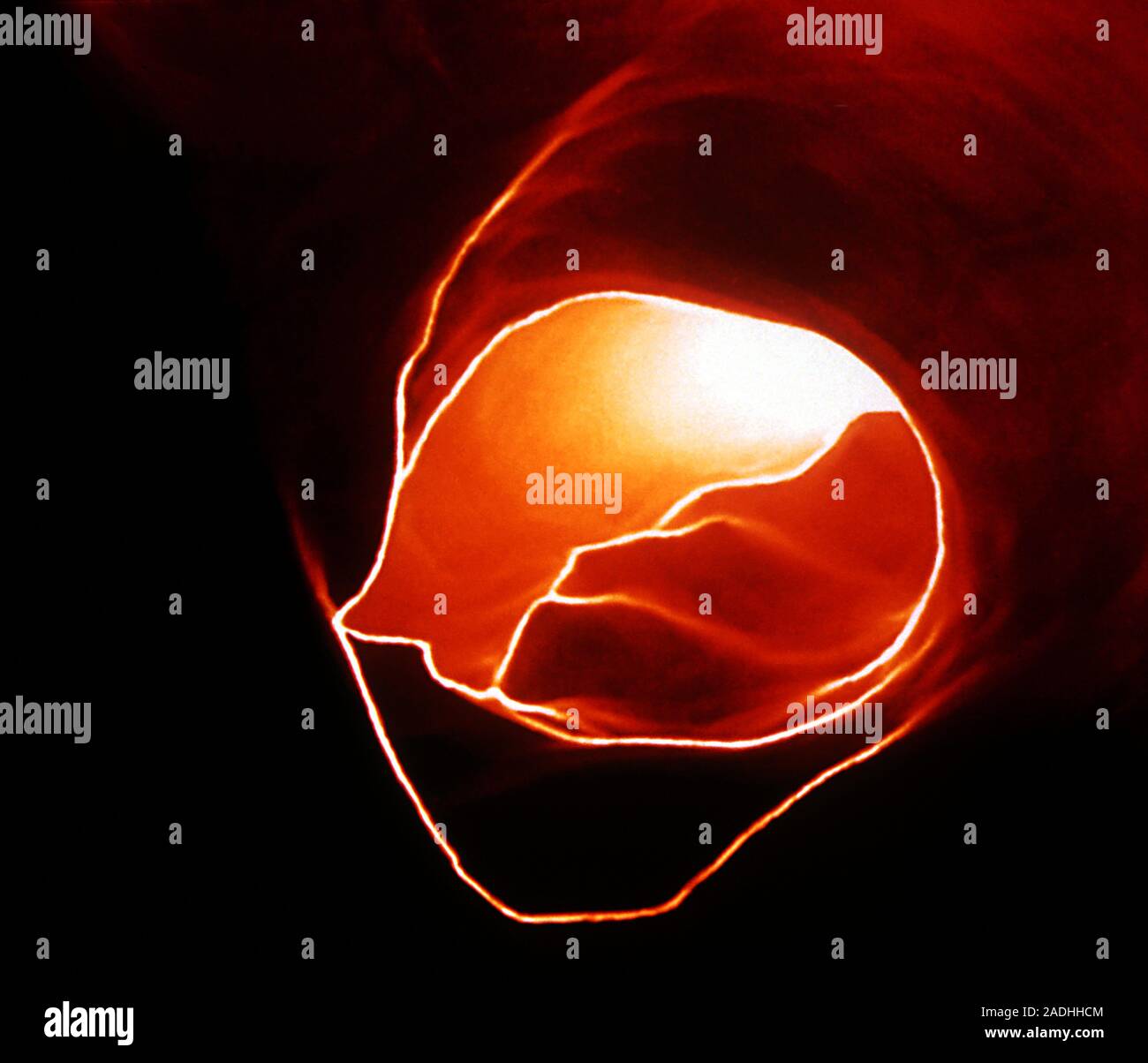 Atherosclerosis. Coloured three-dimensional computed tomography (CT ...