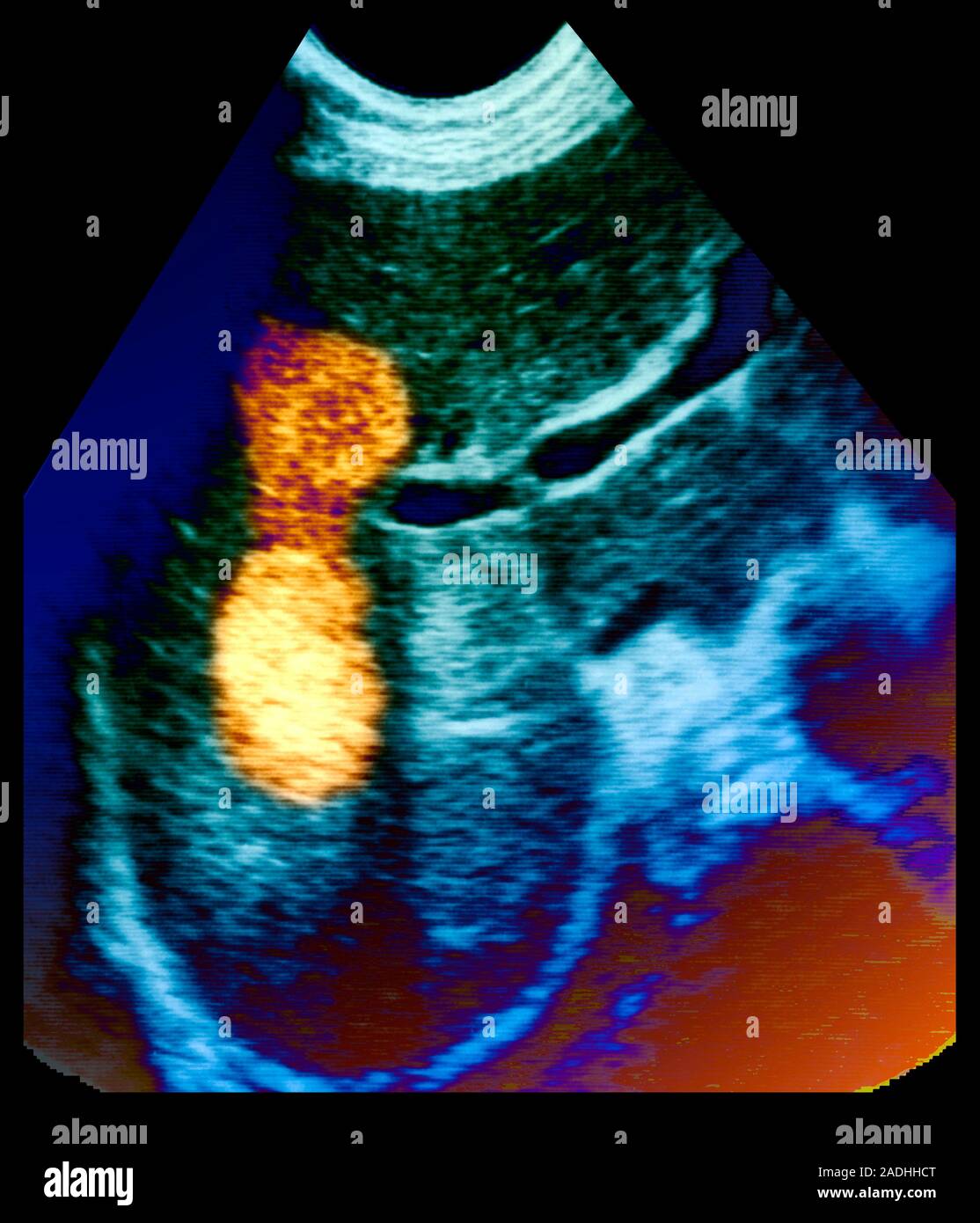 Blood vessel tumour, coloured ultrasound scan. The tumour (orange) is ...