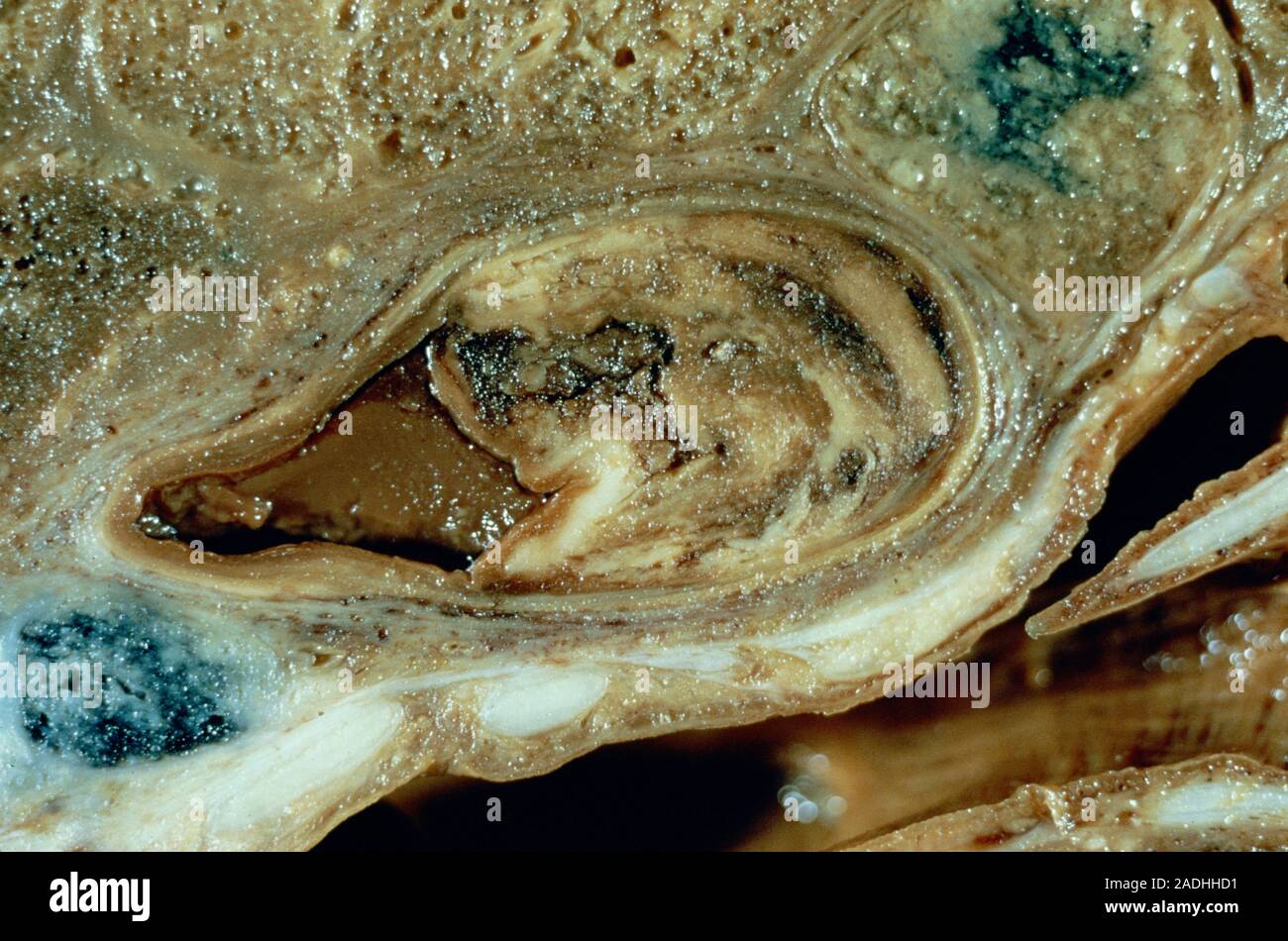 Pulmonary artery blood clot, gross specimen. An abnormal blood clot ...