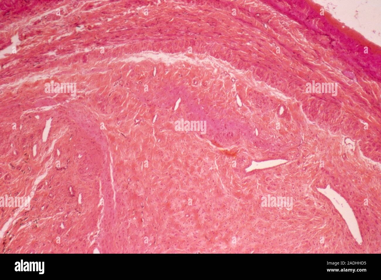 Inflamed vein. Light micrograph of a section through a vein affected by ...