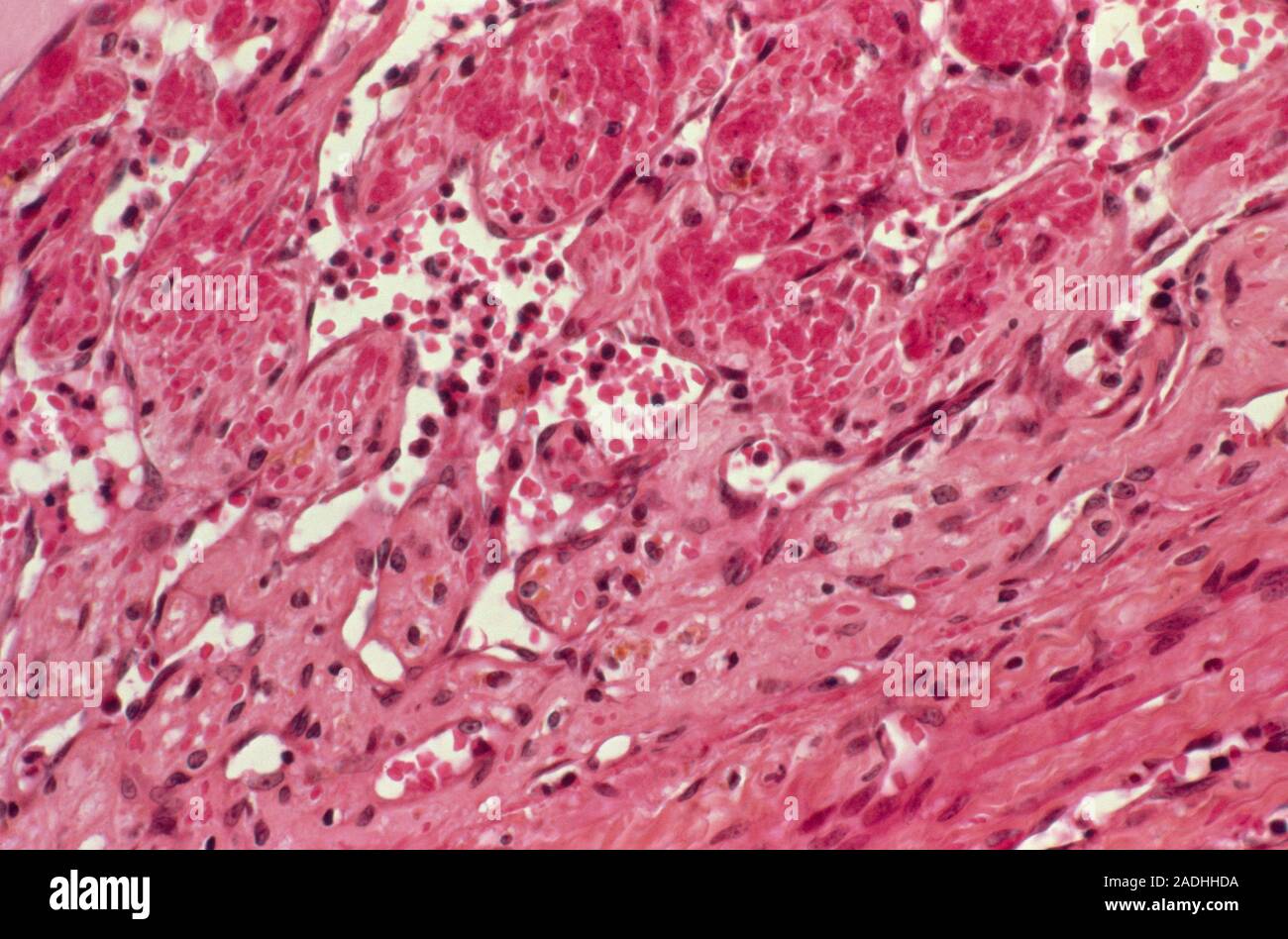 Arterial blood clot. Light micrograph of a section through an arterial ...