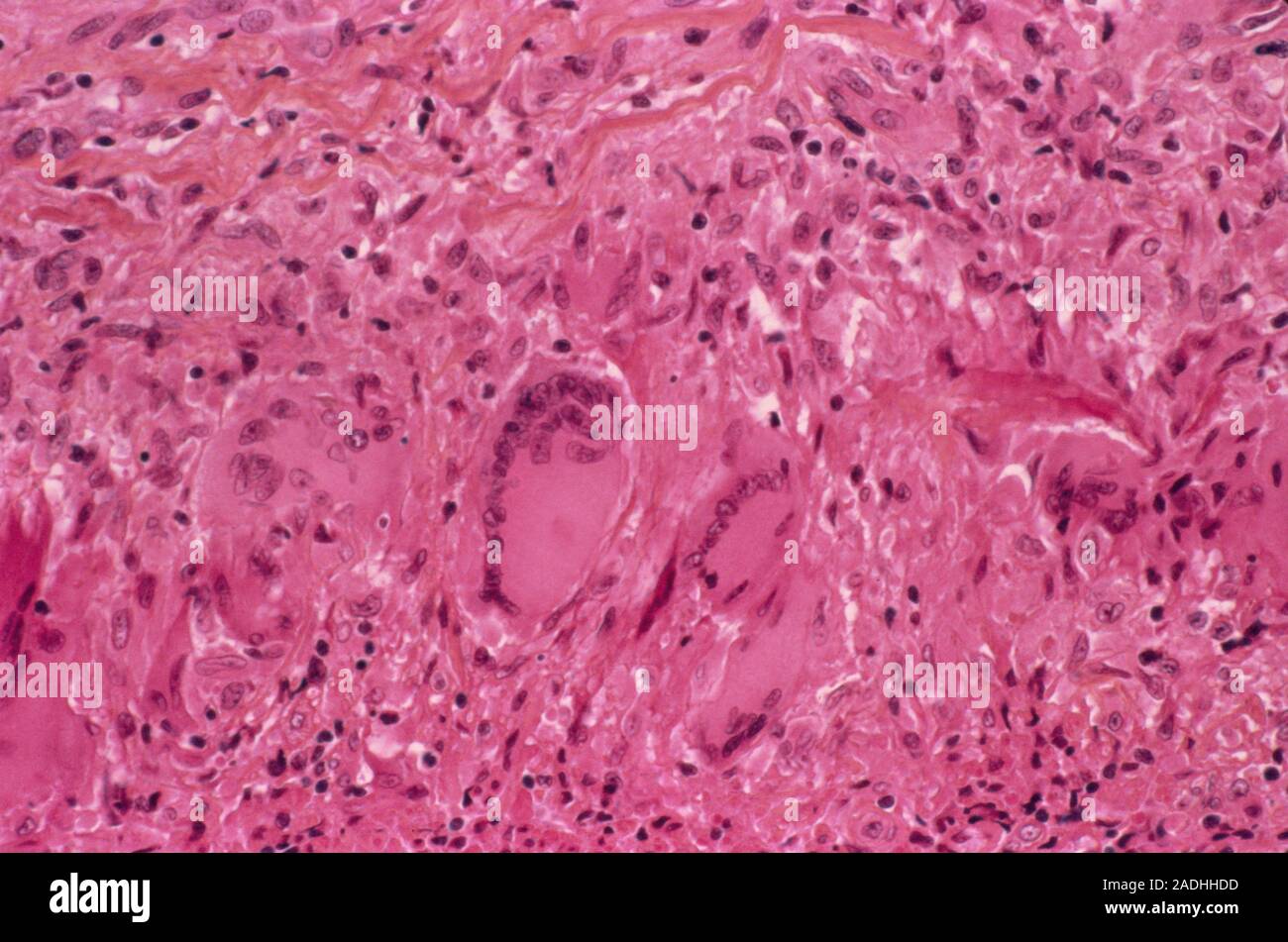 Inflamed arterial tissue. Light micrograph of a section through tissue ...